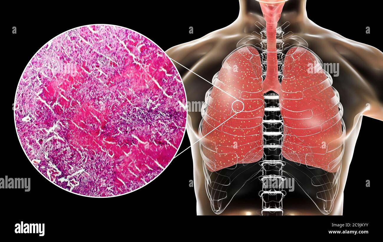 Mycobacterium tuberculosis microscope hi-res stock photography and ...