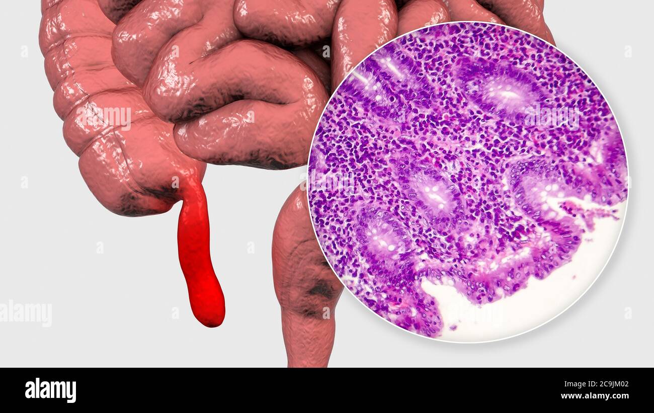 Acute suppurative appendicitis, computer illustration and light ...
