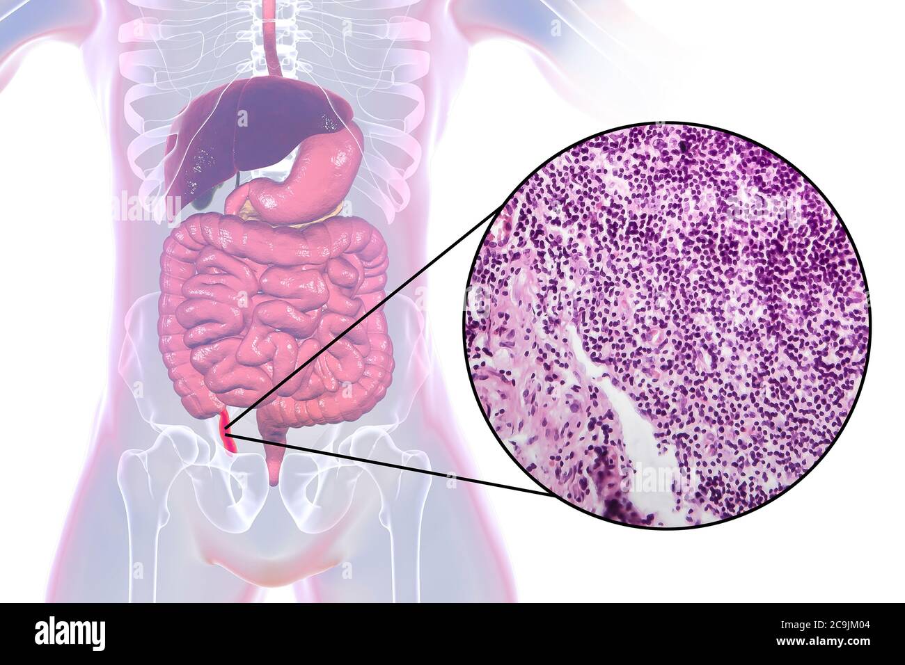 Acute appendicitis, computer illustration and light micrograph ...