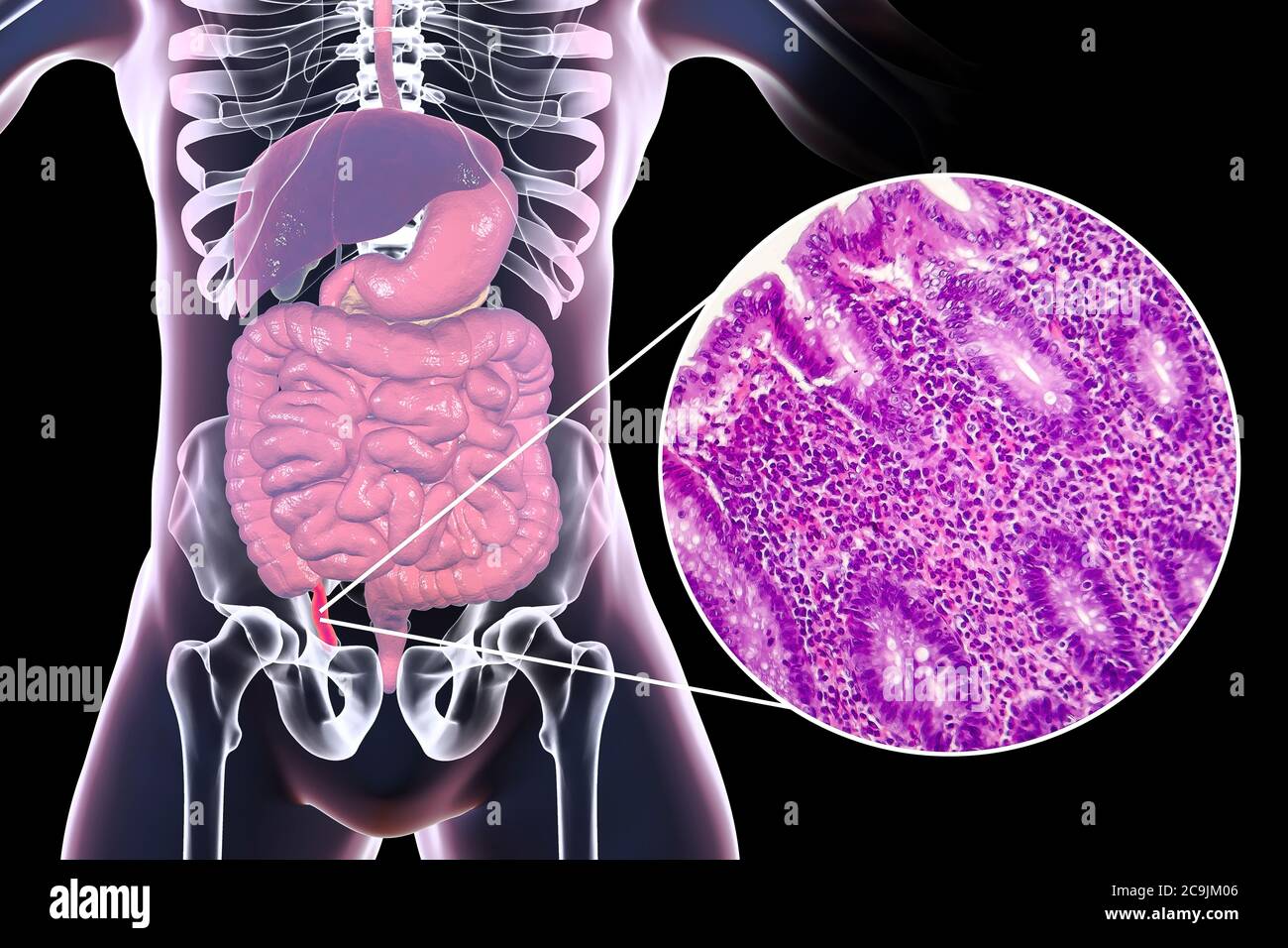 Acute suppurative appendicitis, computer illustration and light ...