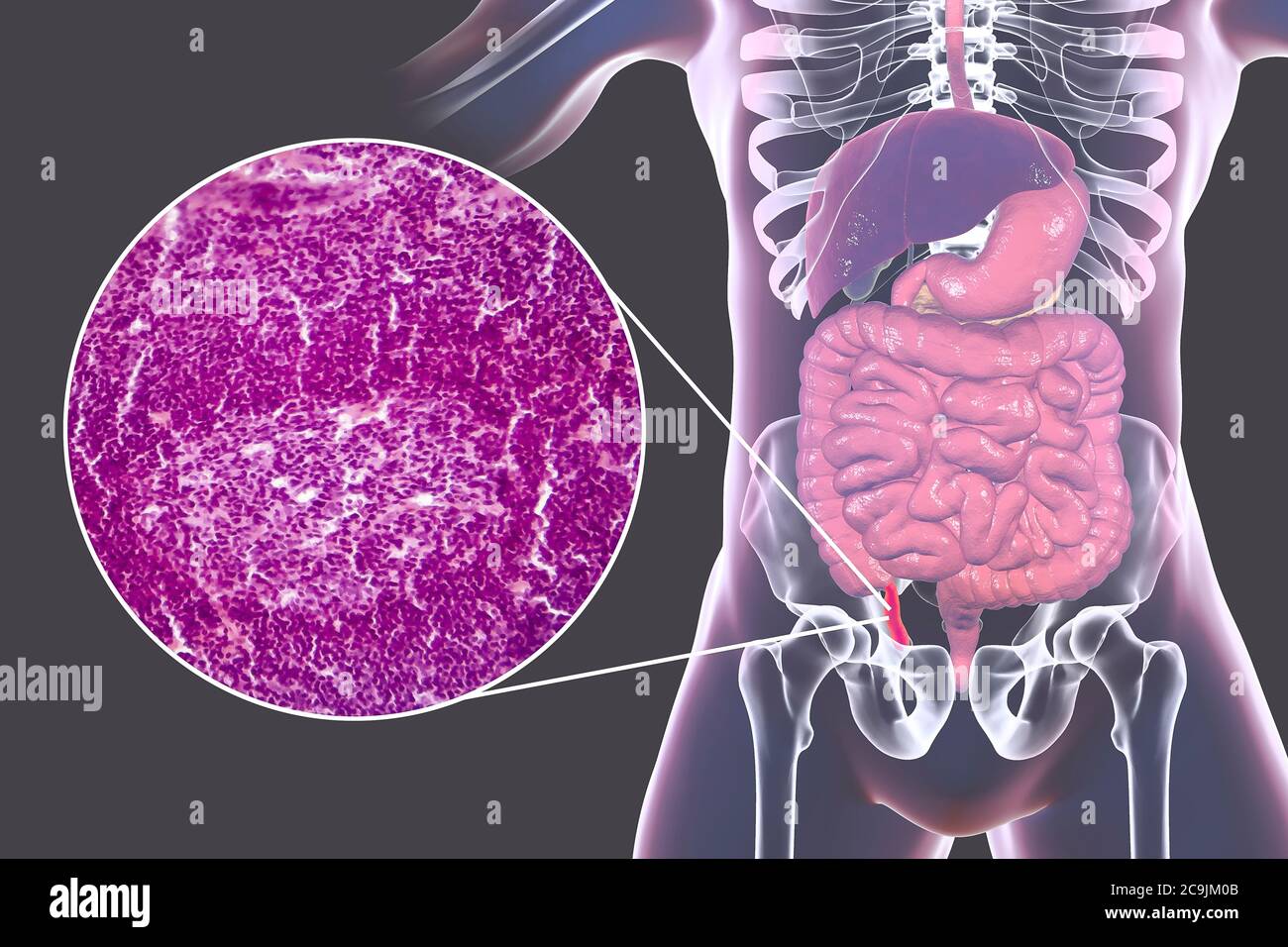 Acute appendicitis, computer illustration and light micrograph ...