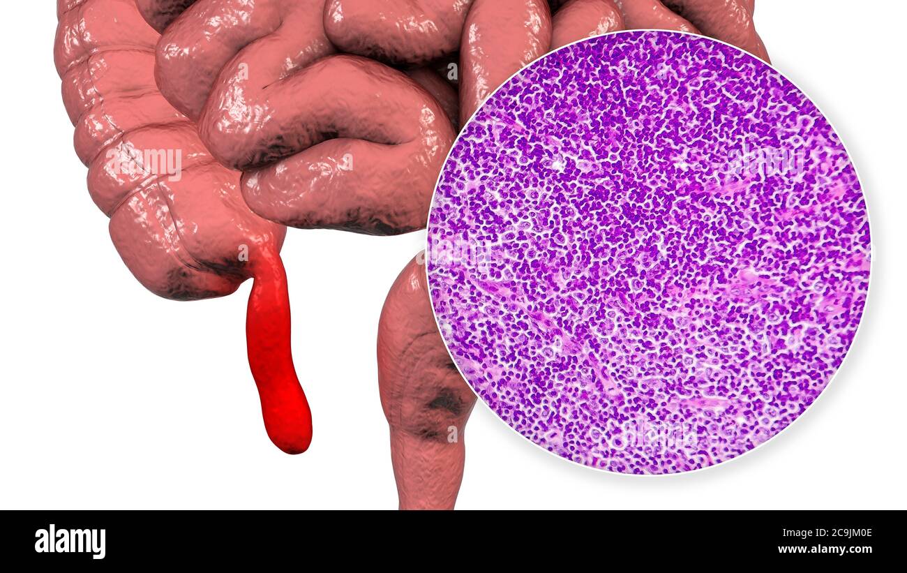 Appendix anatomy micrograph hi-res stock photography and images - Alamy