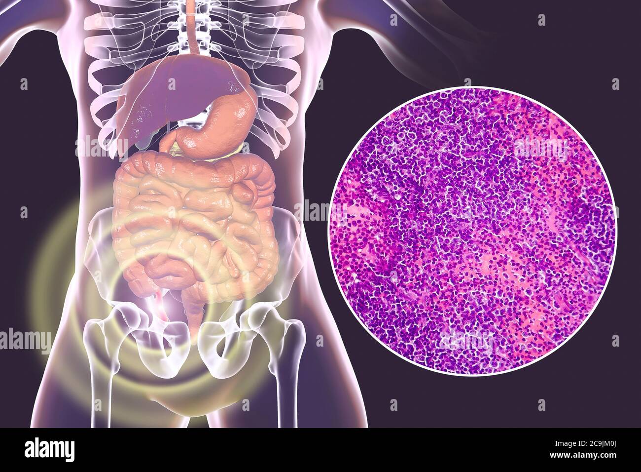 Acute suppurative appendicitis, computer illustration and light ...