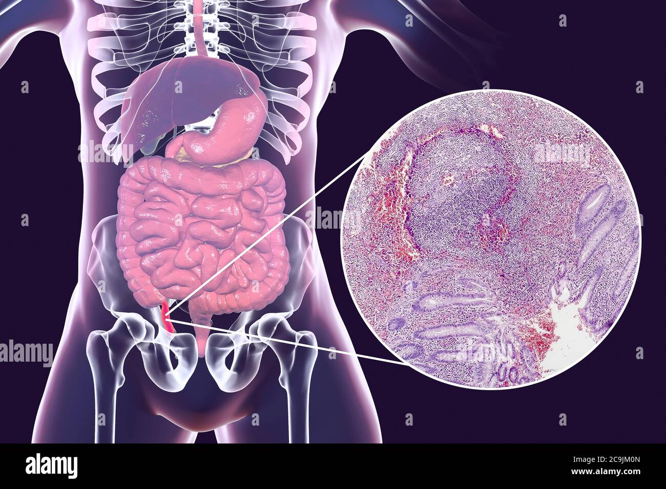 Chronic appendicitis, computer illustration and light micrograph ...