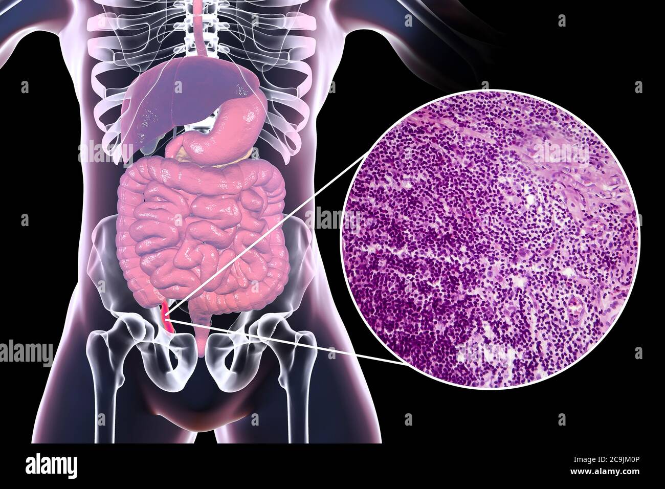 Human Appendix Inflamed