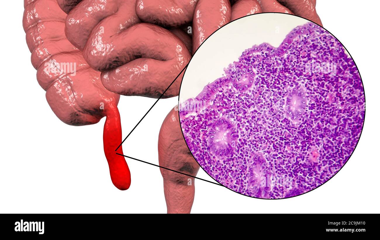 Acute suppurative appendicitis, computer illustration and light ...