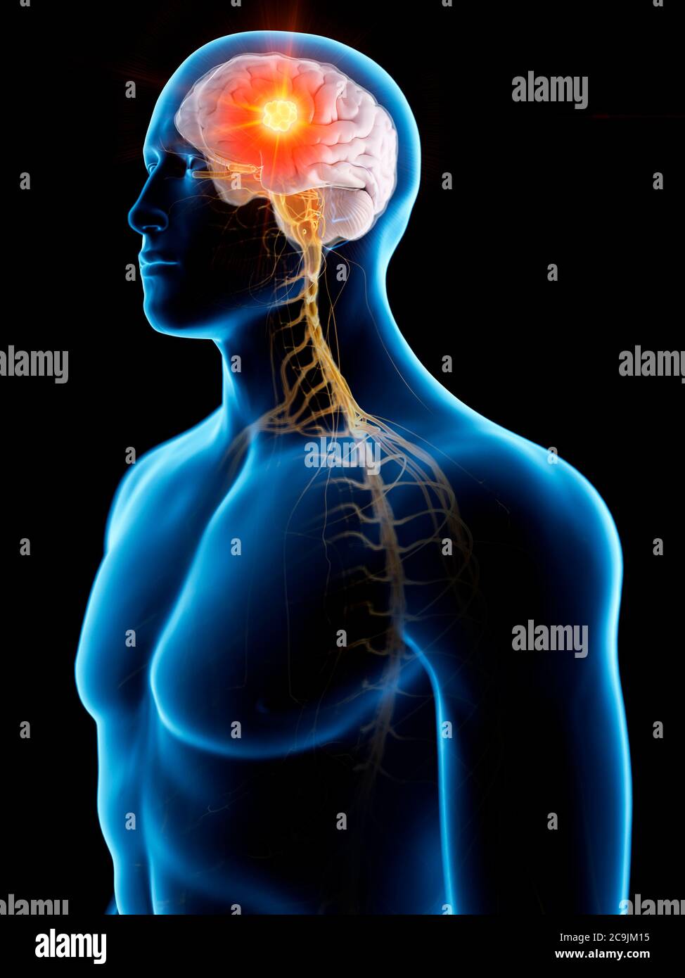 Brain cancer, conceptual computer illustration Stock Photo - Alamy