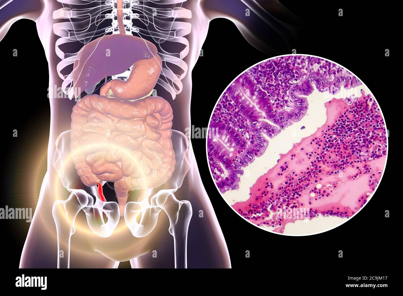 Acute suppurative appendicitis, computer illustration and light ...