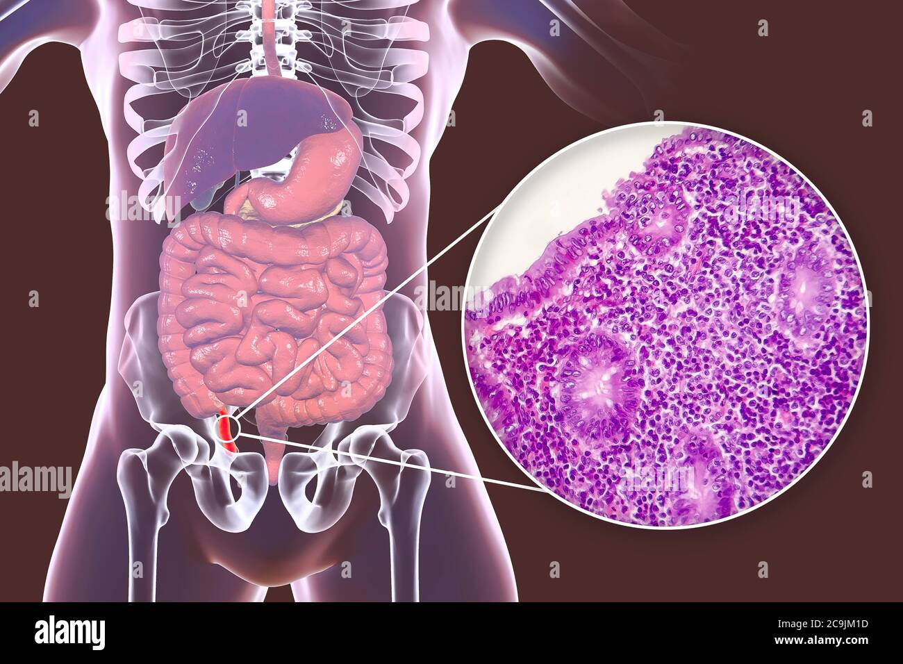 Acute suppurative appendicitis, computer illustration and light ...