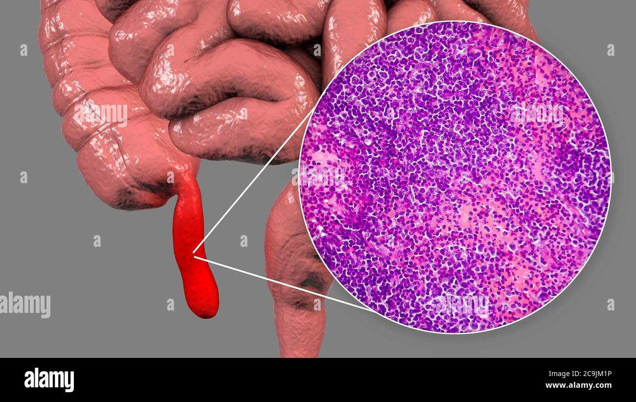 Acute suppurative appendicitis, computer illustration and light ...