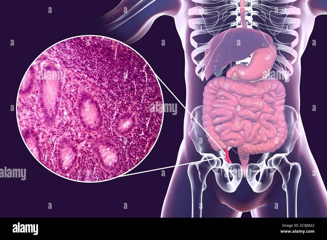 Acute appendicitis, computer illustration and light micrograph ...