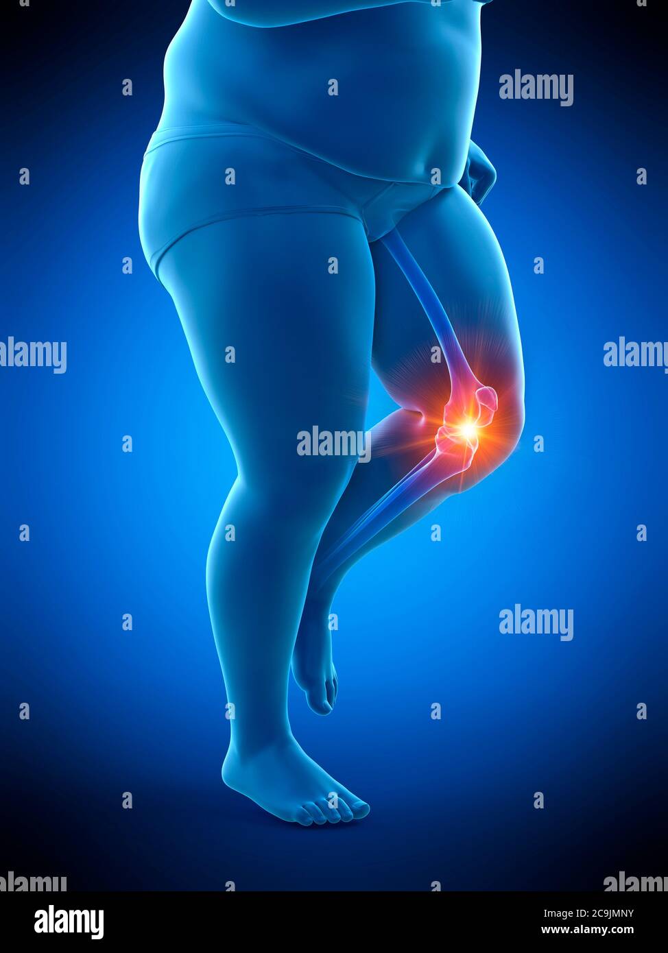 Obese runner with knee pain, computer illustration Stock Photo - Alamy