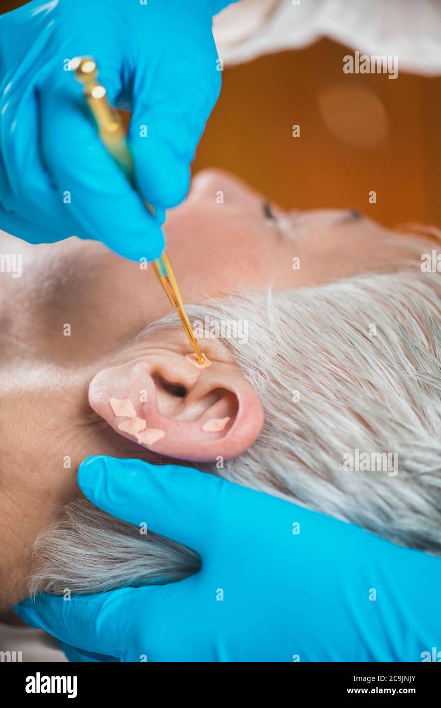 Auriculotherapy, or auricular treatment on human ear, close up ...
