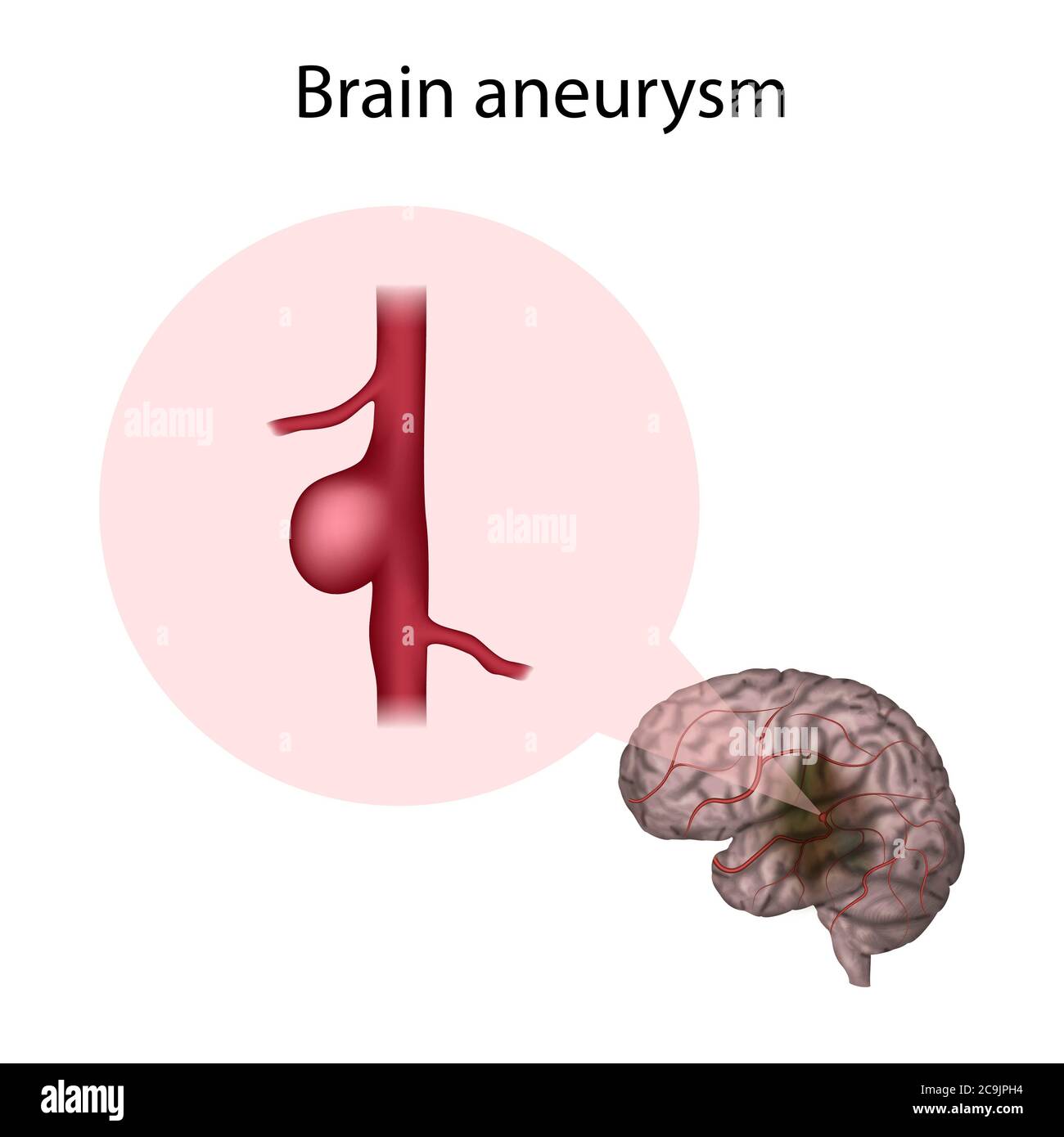 Brain aneurysm, illustration. An aneurysm is a blood-filled dilation in ...