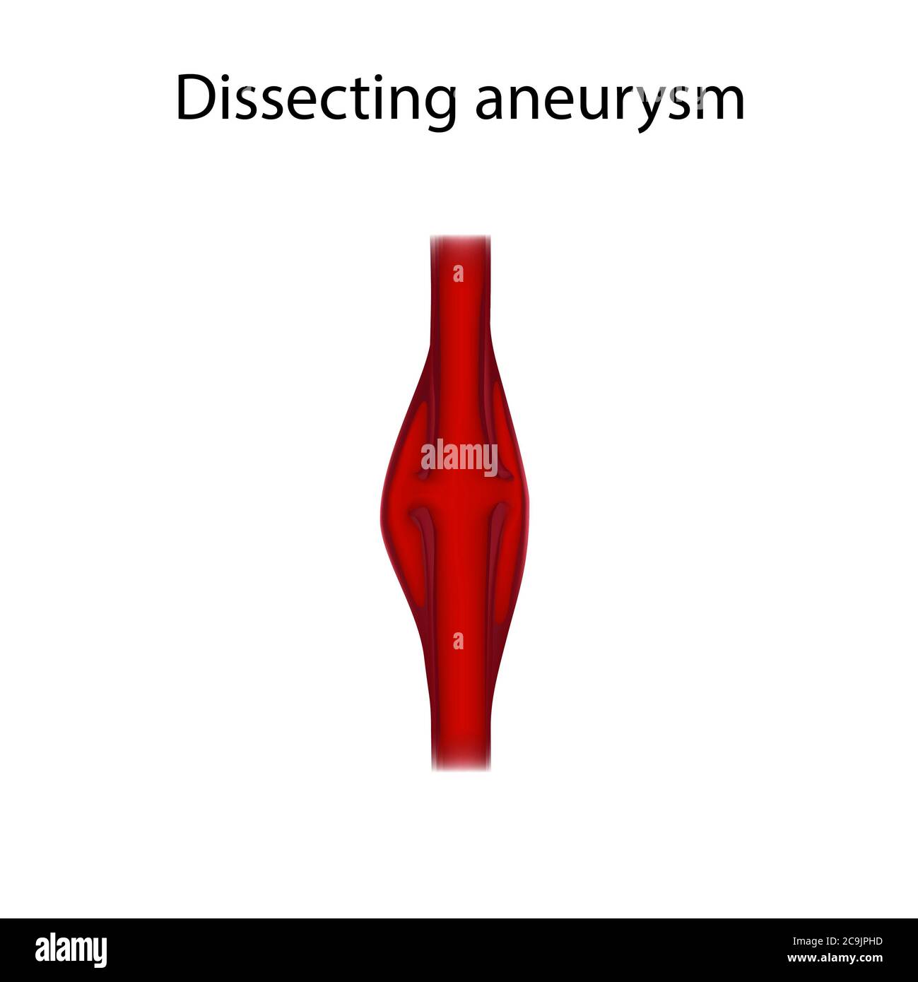 Dissecting aneurysm, illustration. An aneurysm is a blood-filled ...