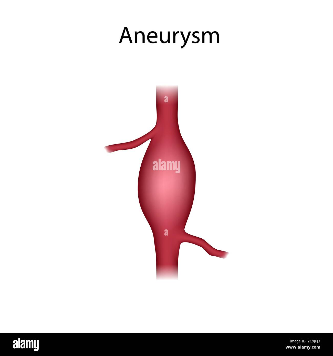 Aneurysm, illustration. An aneurysm is a blood-filled dilation in a ...