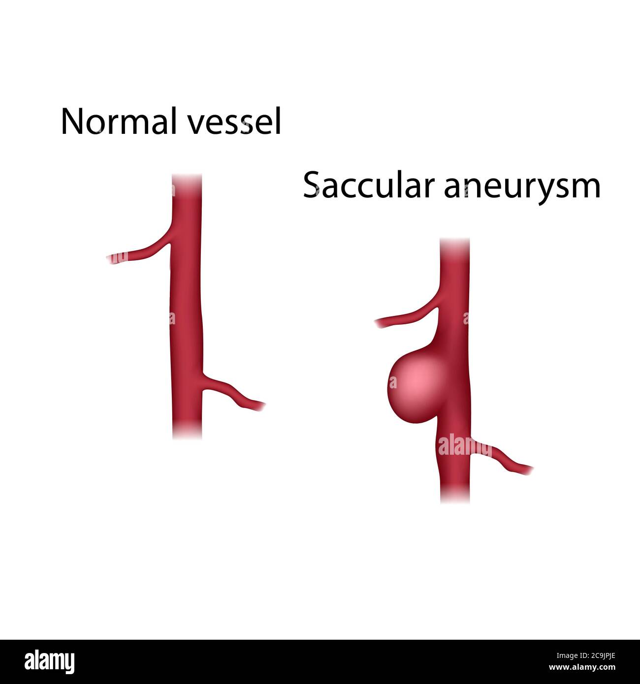 Normal vessel and saccular aneurysm comparison, illustration. An ...