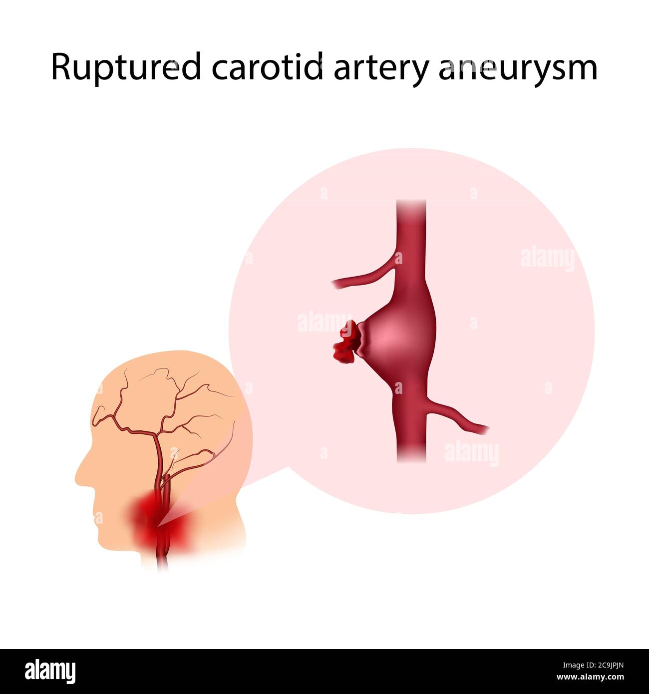 Ruptured carotid artery aneurysm, illustration. An aneurysm is a blood ...