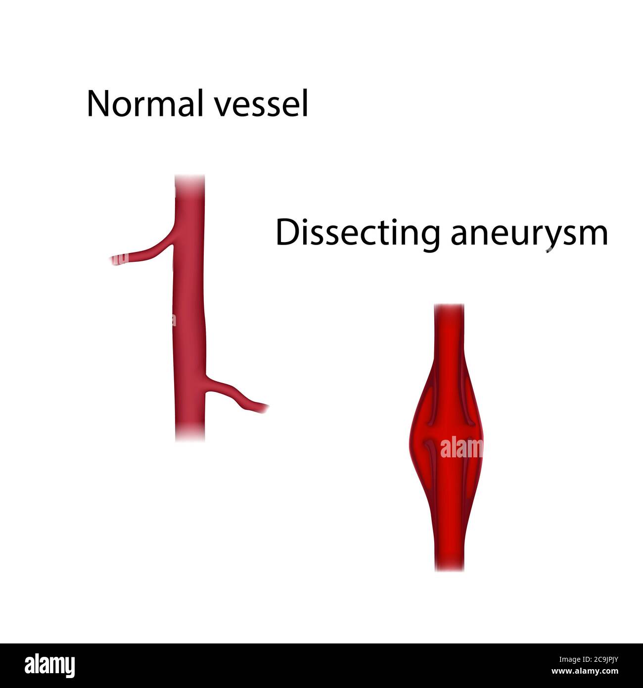 Normal vessel and dissecting aneurysm comparison, illustration. An ...