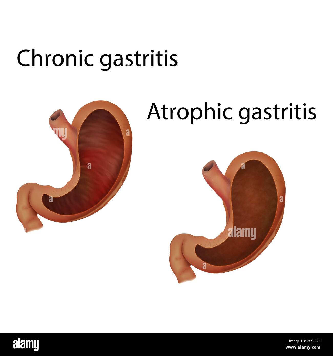 Chronic and atrophic gastritis hi-res stock photography and images - Alamy