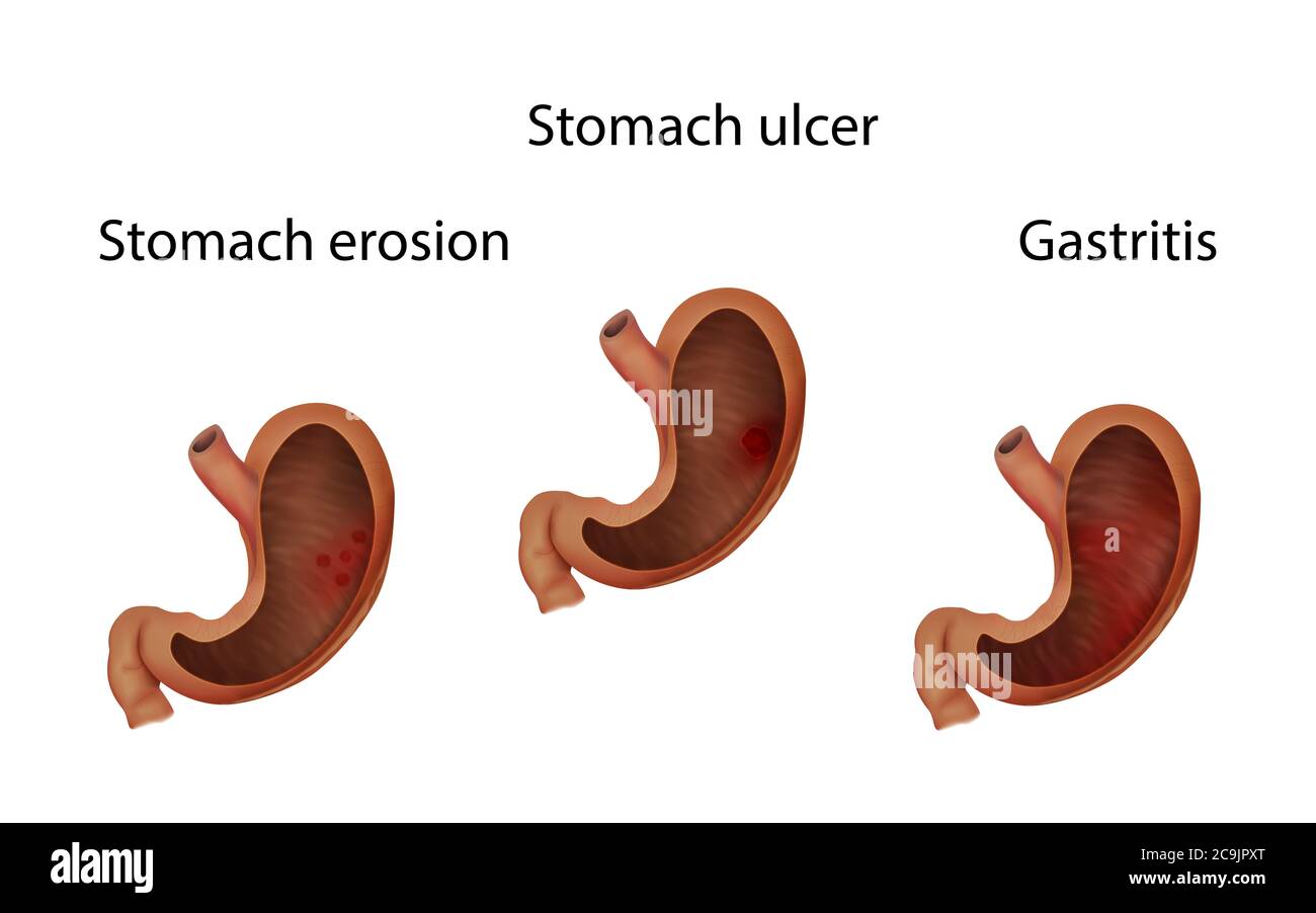 Gastritis and painful human condition Cut Out Stock Images & Pictures ...