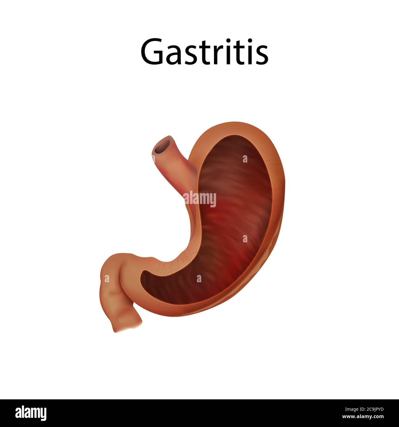 Gastritis hi-res stock photography and images - Alamy