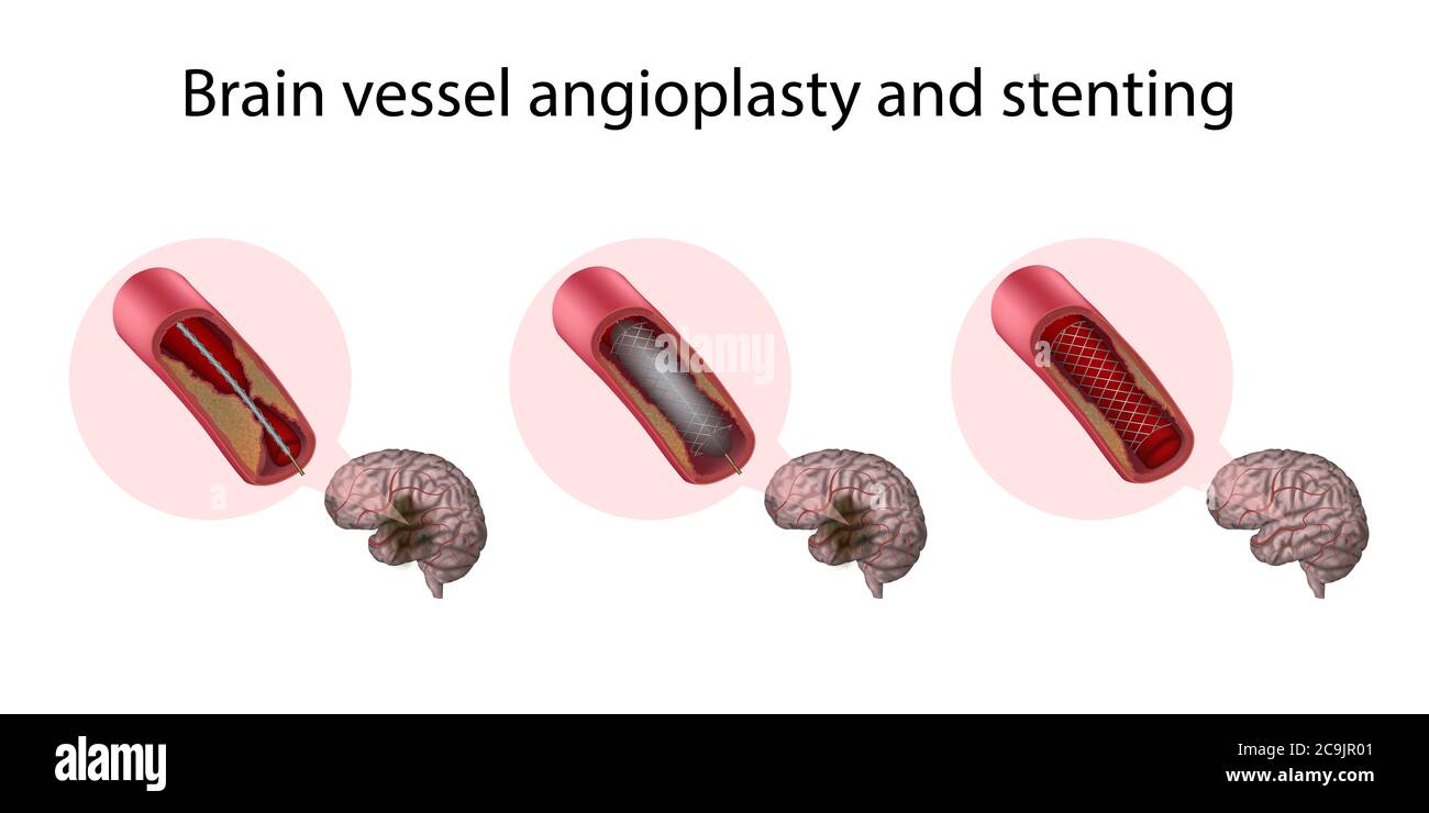 Stages of angioplasty and stenting hi-res stock photography and images ...