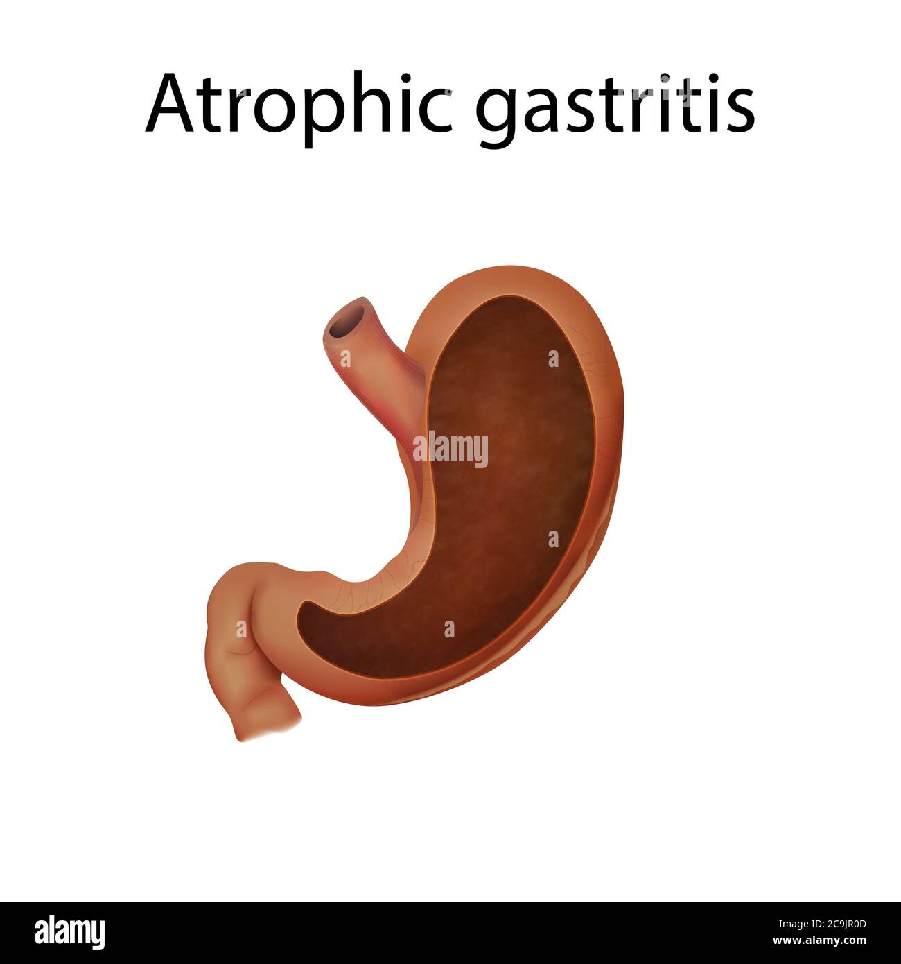 Atrophic gastritis, illustration Stock Photo - Alamy
