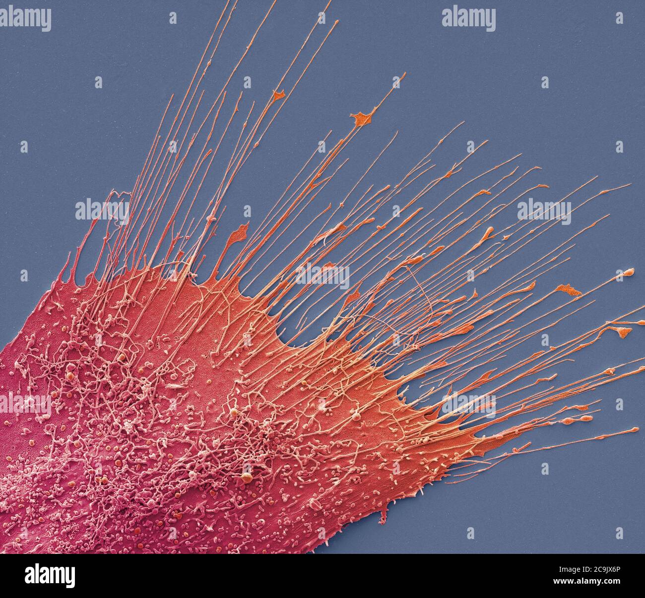 Bone cancer cell. Coloured scanning electron micrograph of an ...