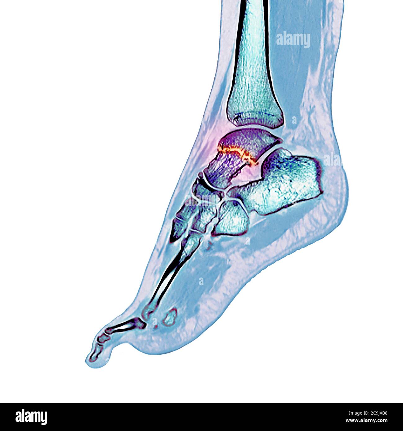 Fractured ankle bone. Coloured computed tomography (CT) scan of the ...