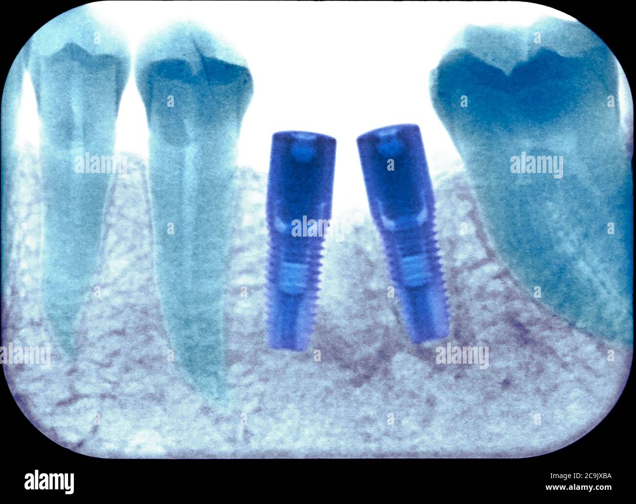 Dental implants following tooth extraction, coloured X-ray. During this ...