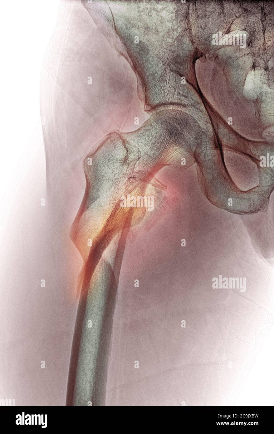 Hip fracture. Coloured frontal X-ray of the right hip of a 53-year-old ...