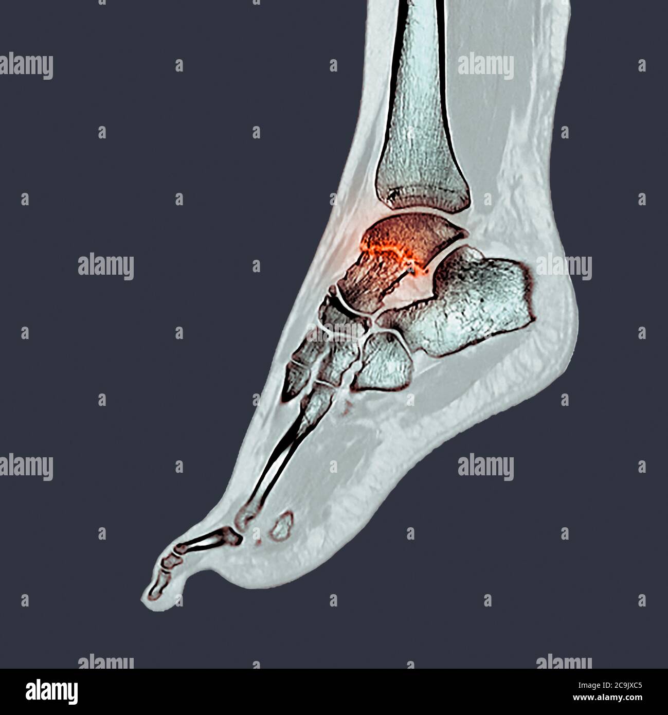 Abnormal bone scan hi-res stock photography and images - Alamy