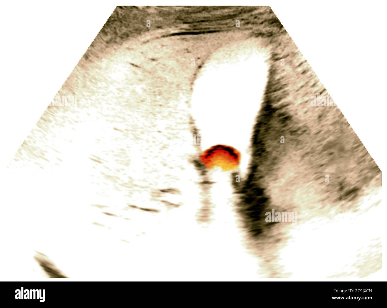 Gallstone. Coloured ultrasound scan of the gallbladder of a 33-year-old ...