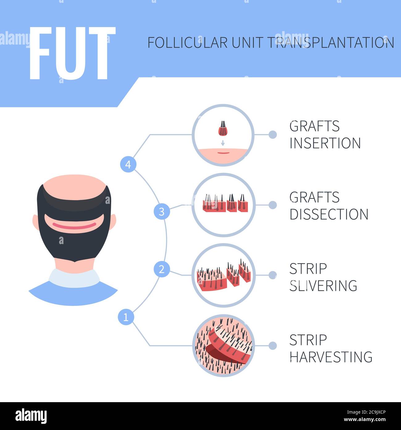 Follicular unit transplantation (FUT hair transplantation in men ...