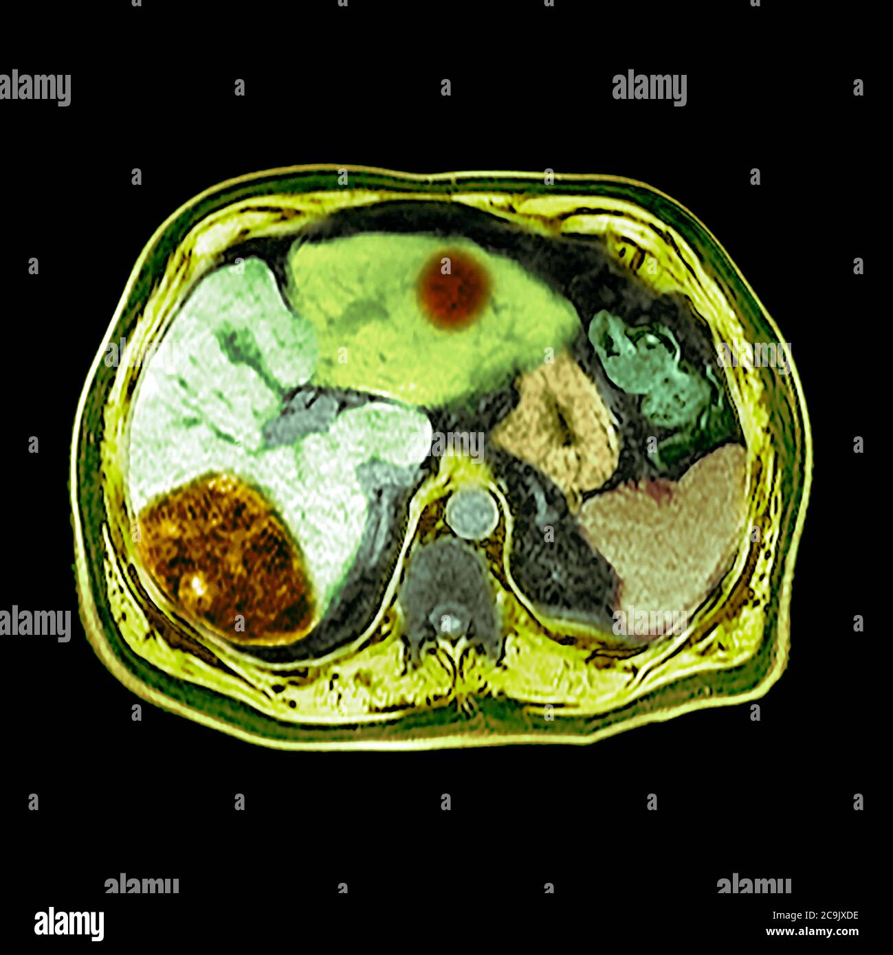 Liver cancer. Coloured axial computed tomography (CT) scan through the ... Liver cancer. Coloured axial computed tomography (CT) scan through the ...