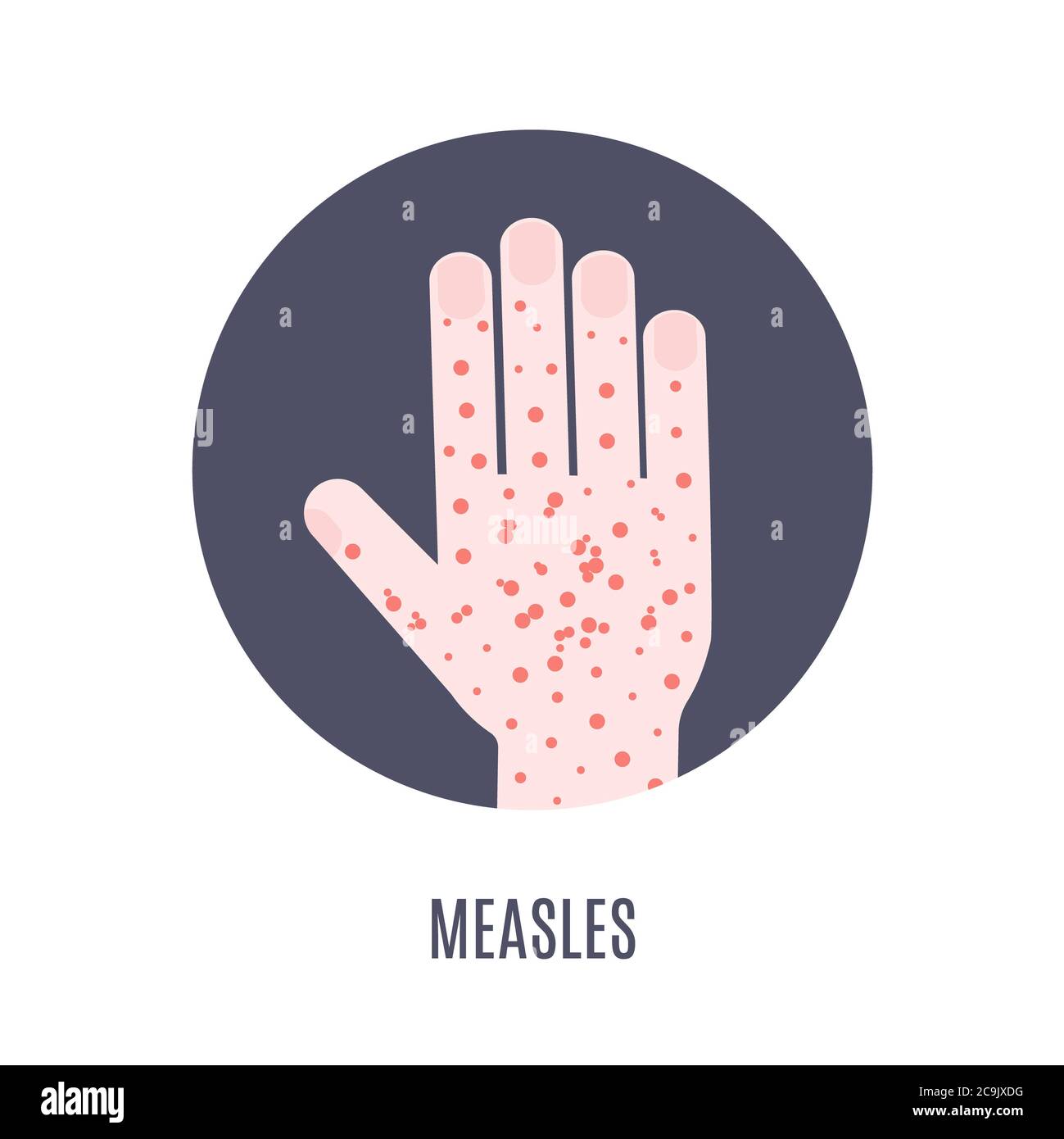 Measles awareness, illustration Stock Photo - Alamy