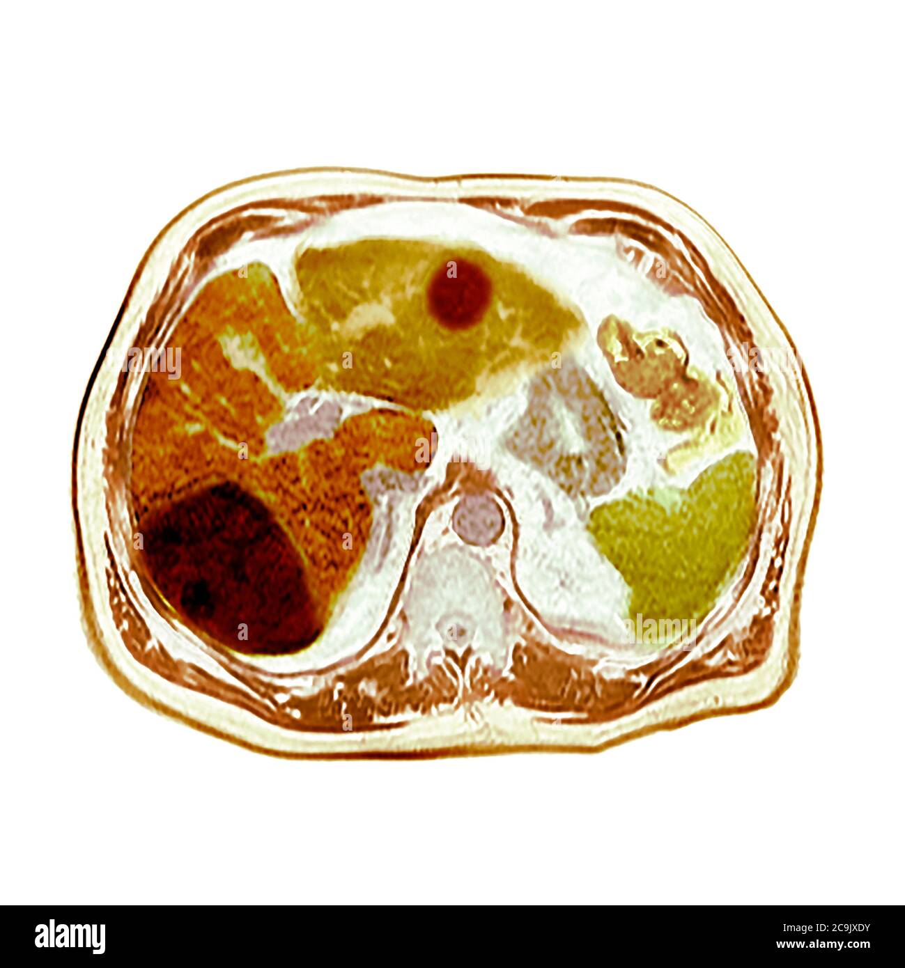 Liver cancer. Coloured axial computed tomography (CT) scan through the ... Liver cancer. Coloured axial computed tomography (CT) scan through the ...