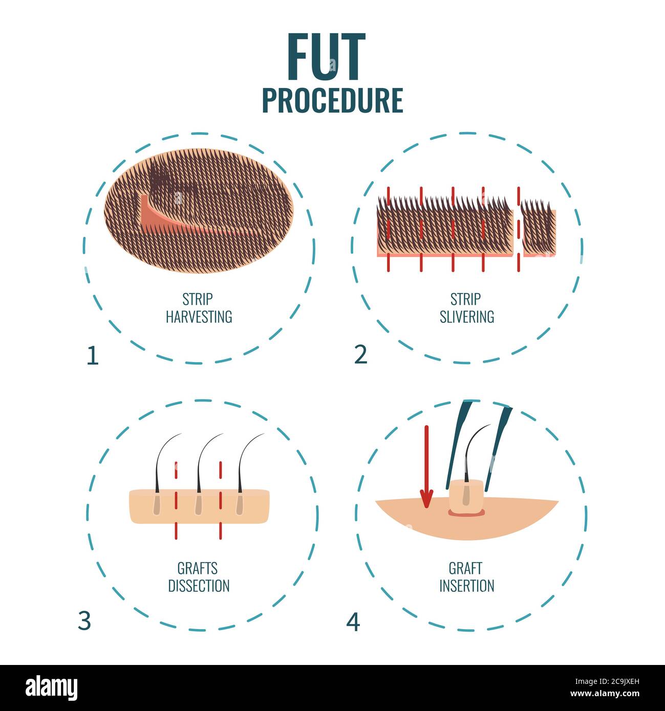 Follicular Unit Transplantation Fut Hair Transplantation Stages