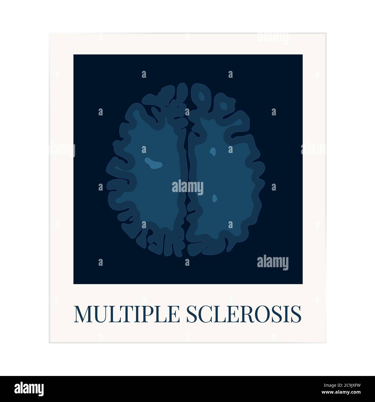 Multiple sclerosis illustration hi-res stock photography and images - Alamy