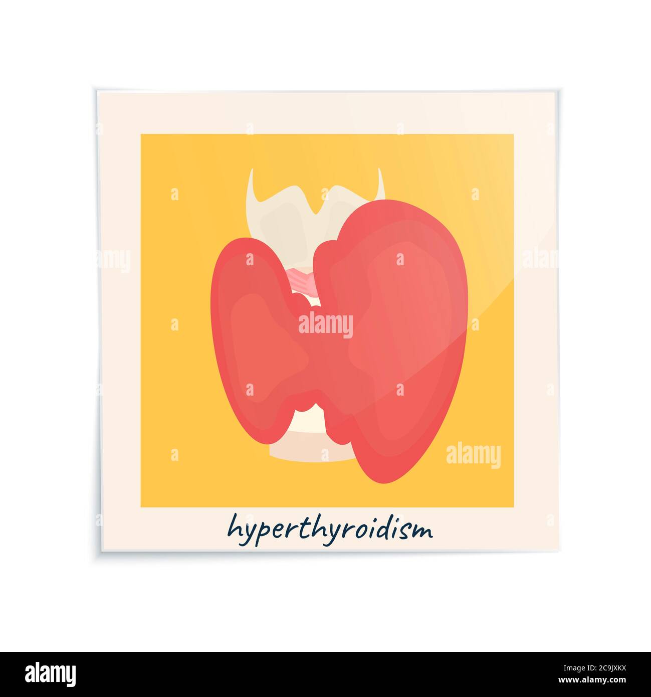 Thyroid gland disorder, illustration Stock Photo - Alamy
