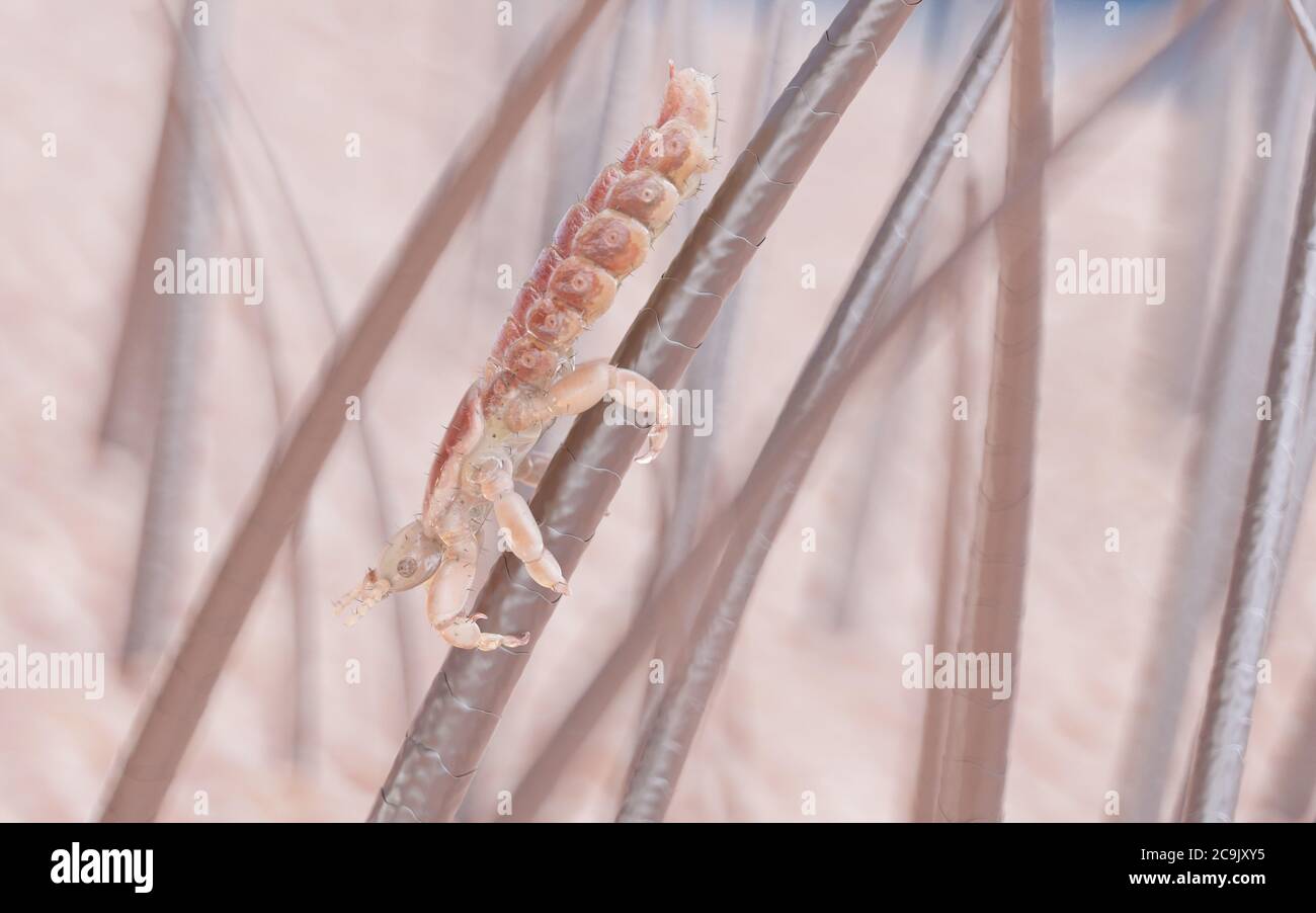 Head louse on a human head, computer illustration Stock Photo - Alamy