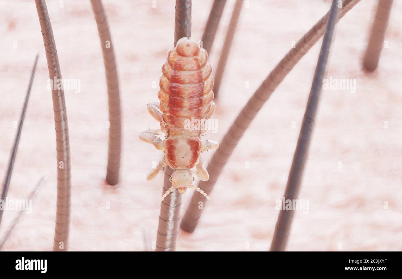 Head louse, computer illustration Stock Photo - Alamy