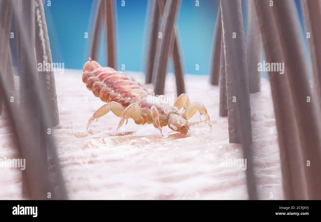 Head louse on a human head, computer illustration Stock Photo - Alamy