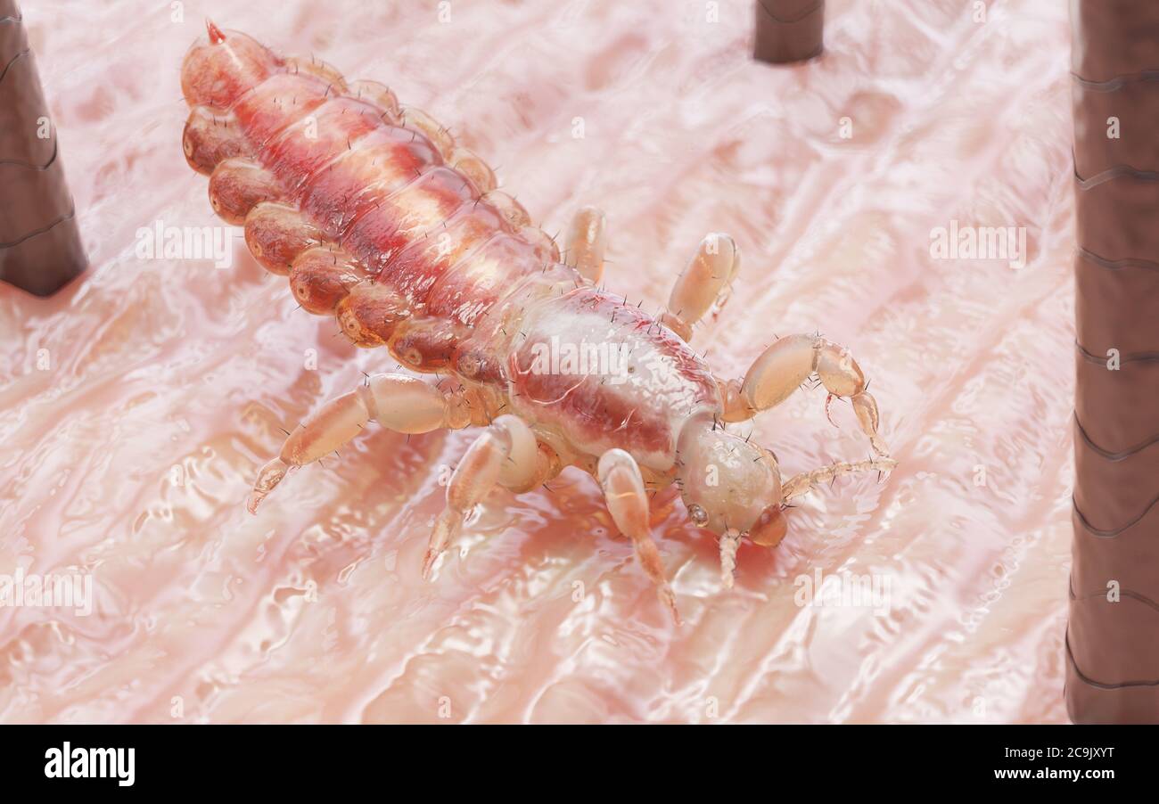 Head louse on a human head, computer illustration Stock Photo - Alamy