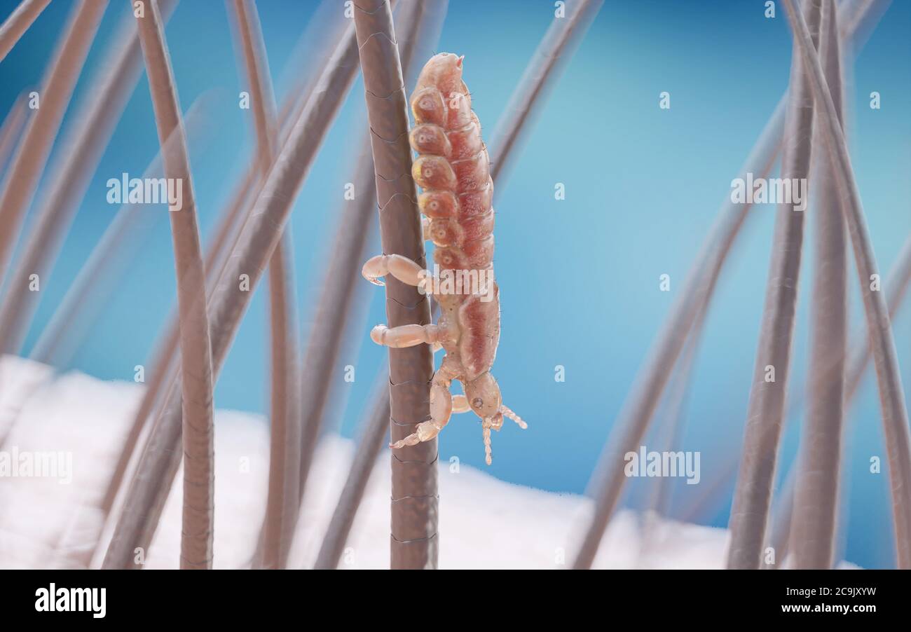 Head louse on a human head, computer illustration Stock Photo - Alamy