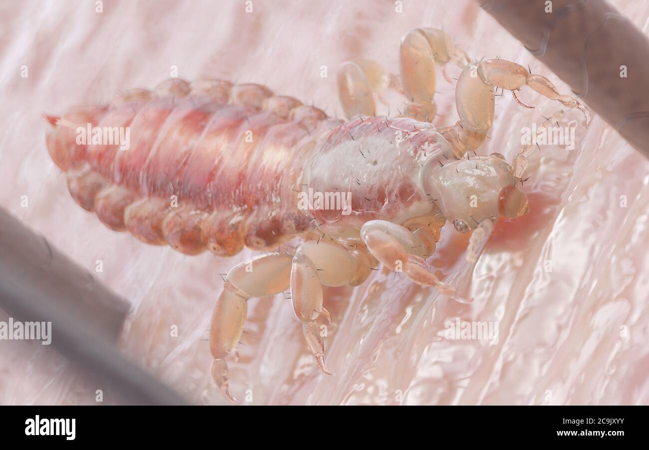 Head louse on a human head, computer illustration Stock Photo - Alamy