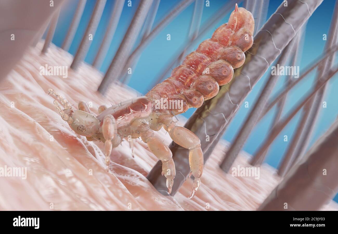 Head louse, computer illustration Stock Photo - Alamy