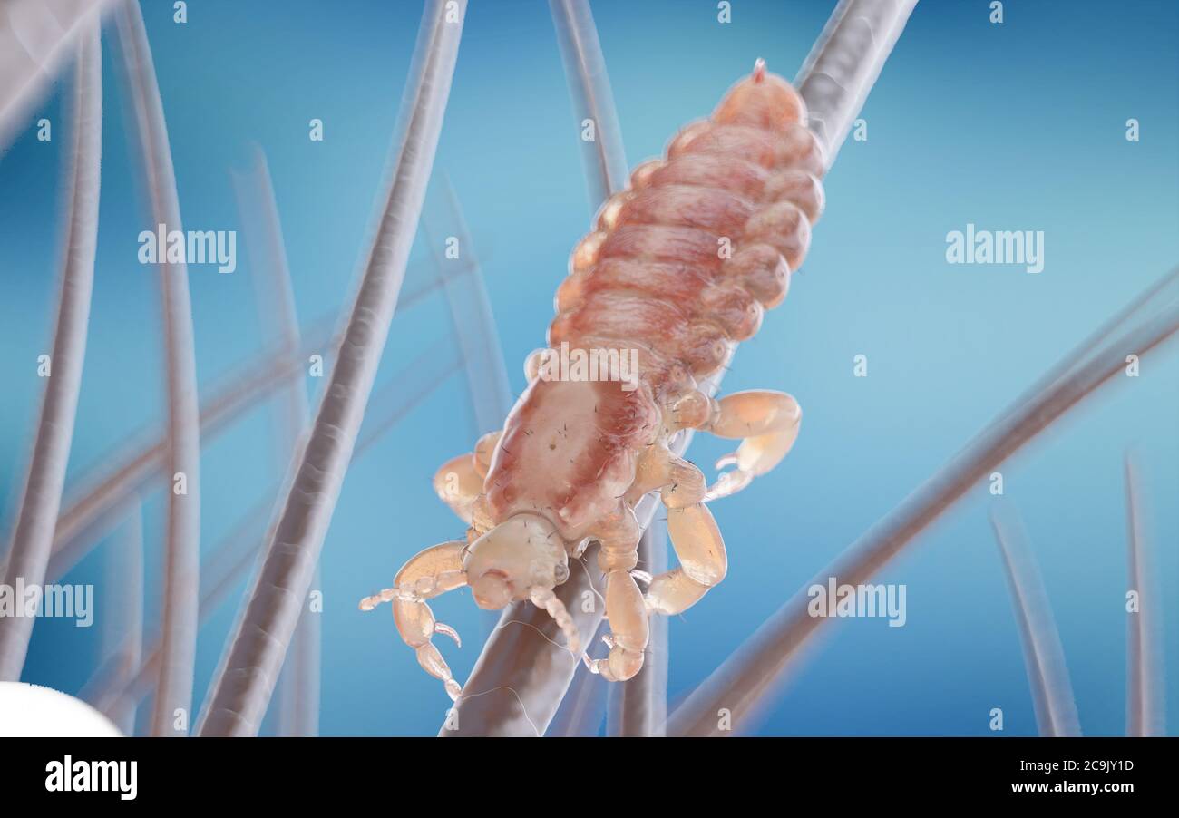 Head louse on a human head, computer illustration Stock Photo - Alamy