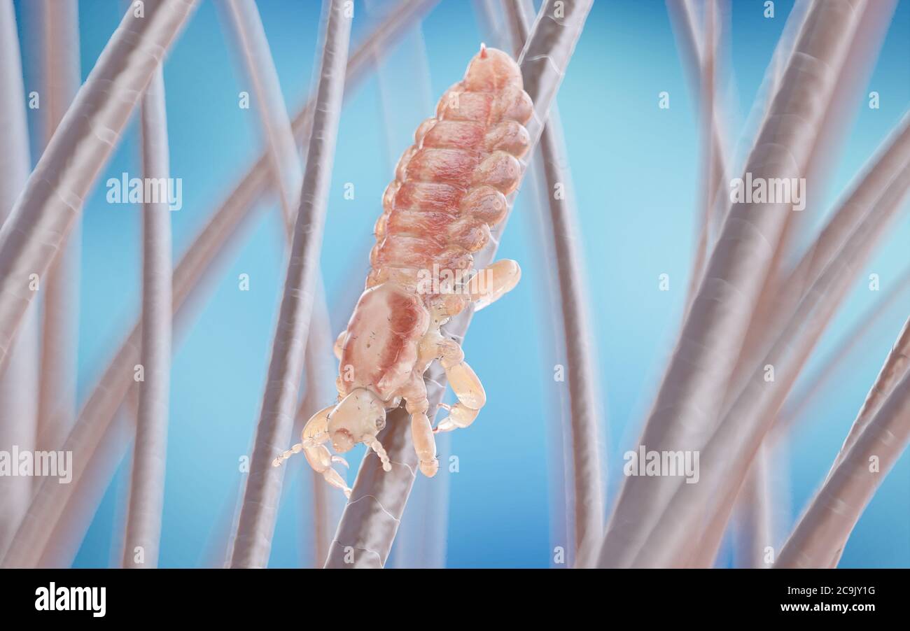 Head louse on a human head, computer illustration Stock Photo - Alamy